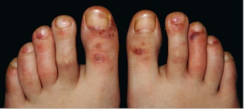 Common Toe Deformities | Sforzo Dillingham
